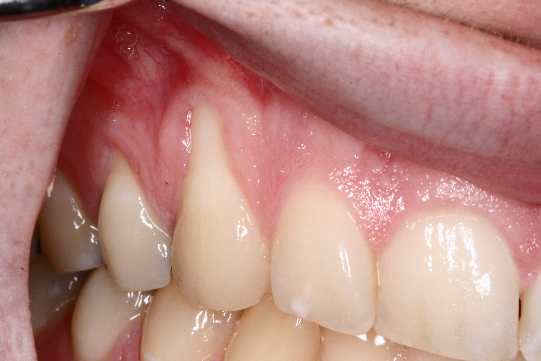 Santa Rosa | Gum Grafting | Gum Recession | Repair Receding Gums